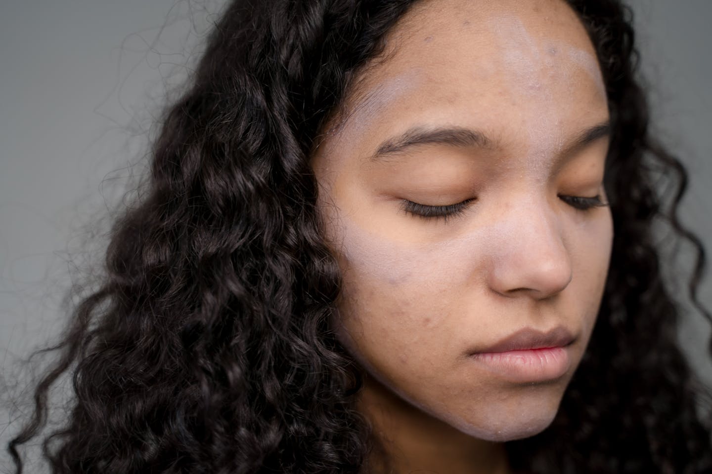 Dealing with Acne Scars: Treatments and Recovery - Advanced Skin ...